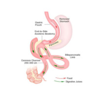 Single Anastomosis Duodenoileal Bypass (SADI) - Weight Loss Surgeon
